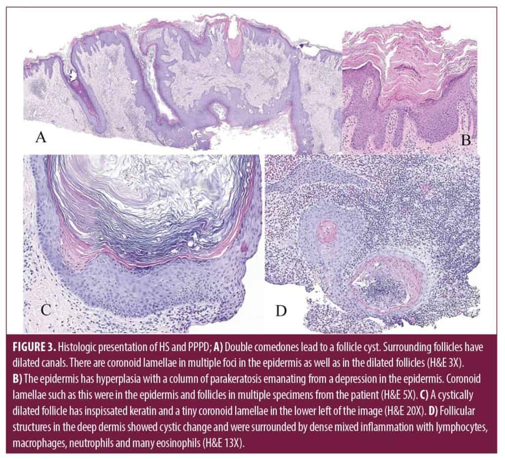 Concomitance of Hidradenitis Suppurativa and Porokeratoses | JCAD - The ...