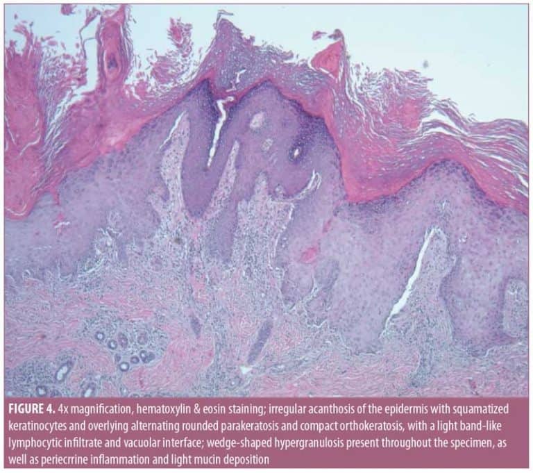 Lupus Erythematosus Lichen Planus Overlap Syndrome Mimicking Squamous ...