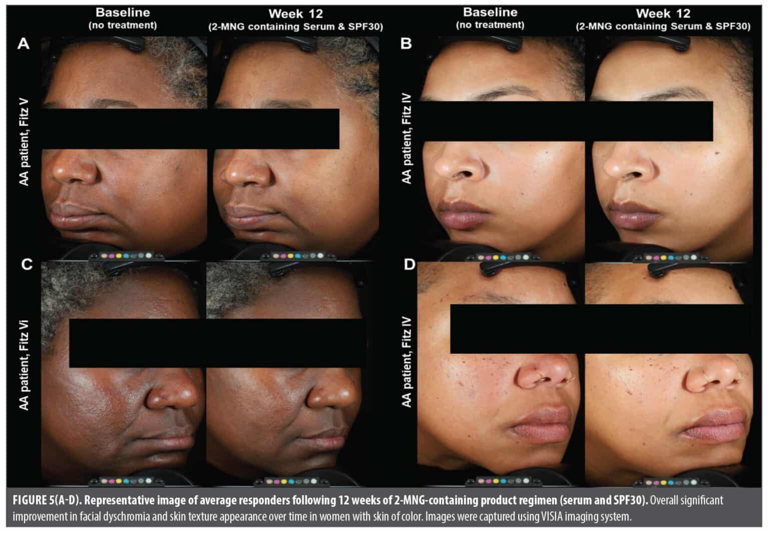 Efficacy of a 2-MNG-Containing Serum and Sunscreen Regimen on Improving ...
