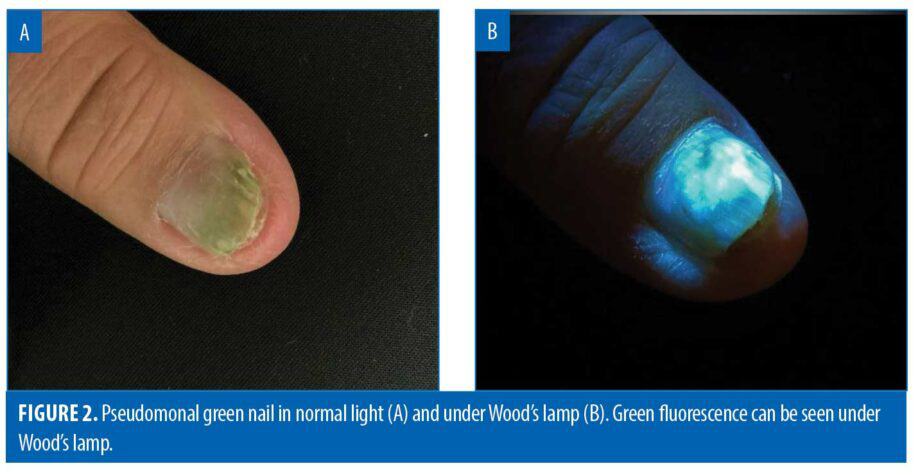 Revealing The Unseen: A Review of Wood's Lamp in Dermatology | JCAD ...