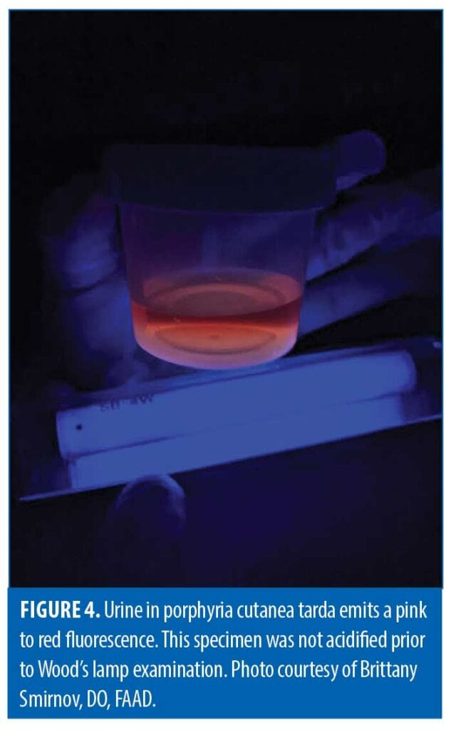 Revealing The Unseen: A Review of Wood's Lamp in Dermatology | JCAD ...