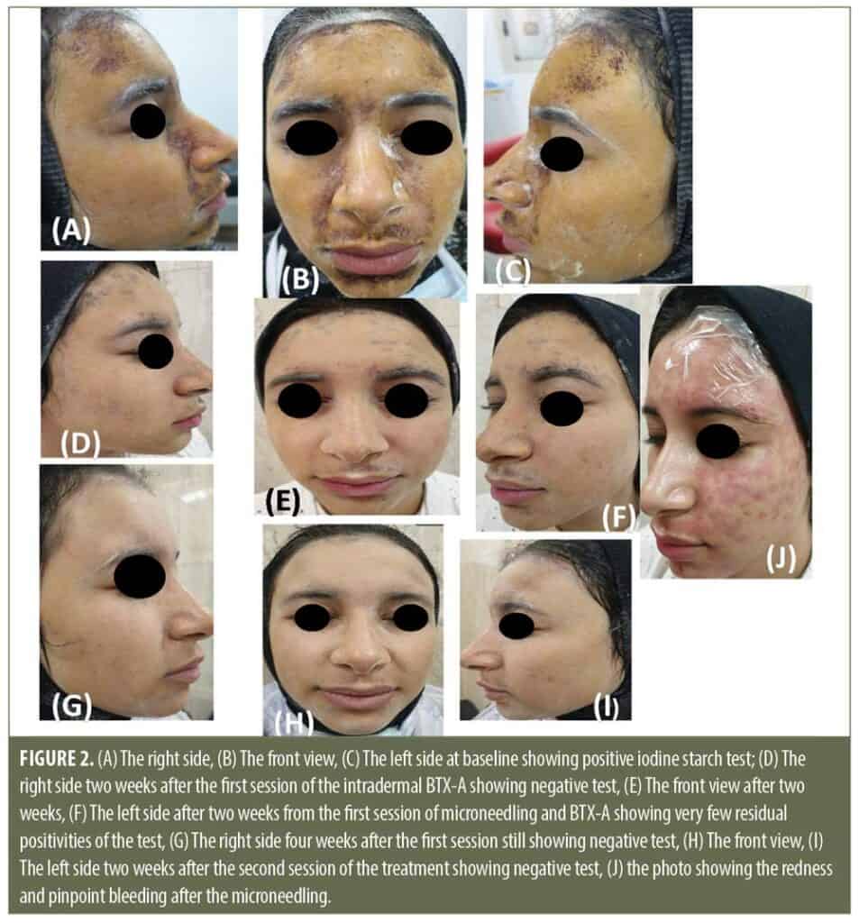 Microneedling Delivery of Botulinum Toxin Versus Intradermal Injection ...