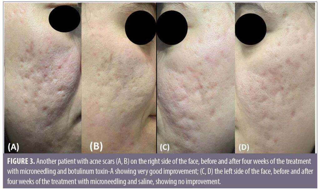 Successful Topical Application of Botulinum Toxin After Microneedling ...