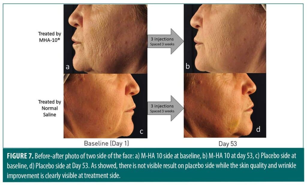 The Effects of a Non-crossed-linked Hyaluronic Acid Gel on the Aging ...