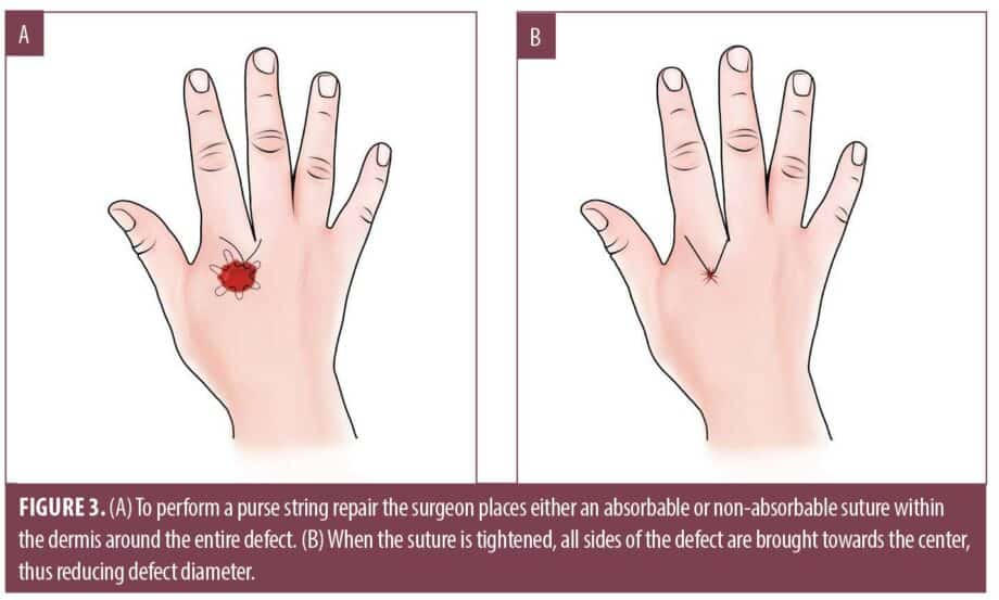 Review of Cutaneous Repairs on the Hand and Fingers Following ...