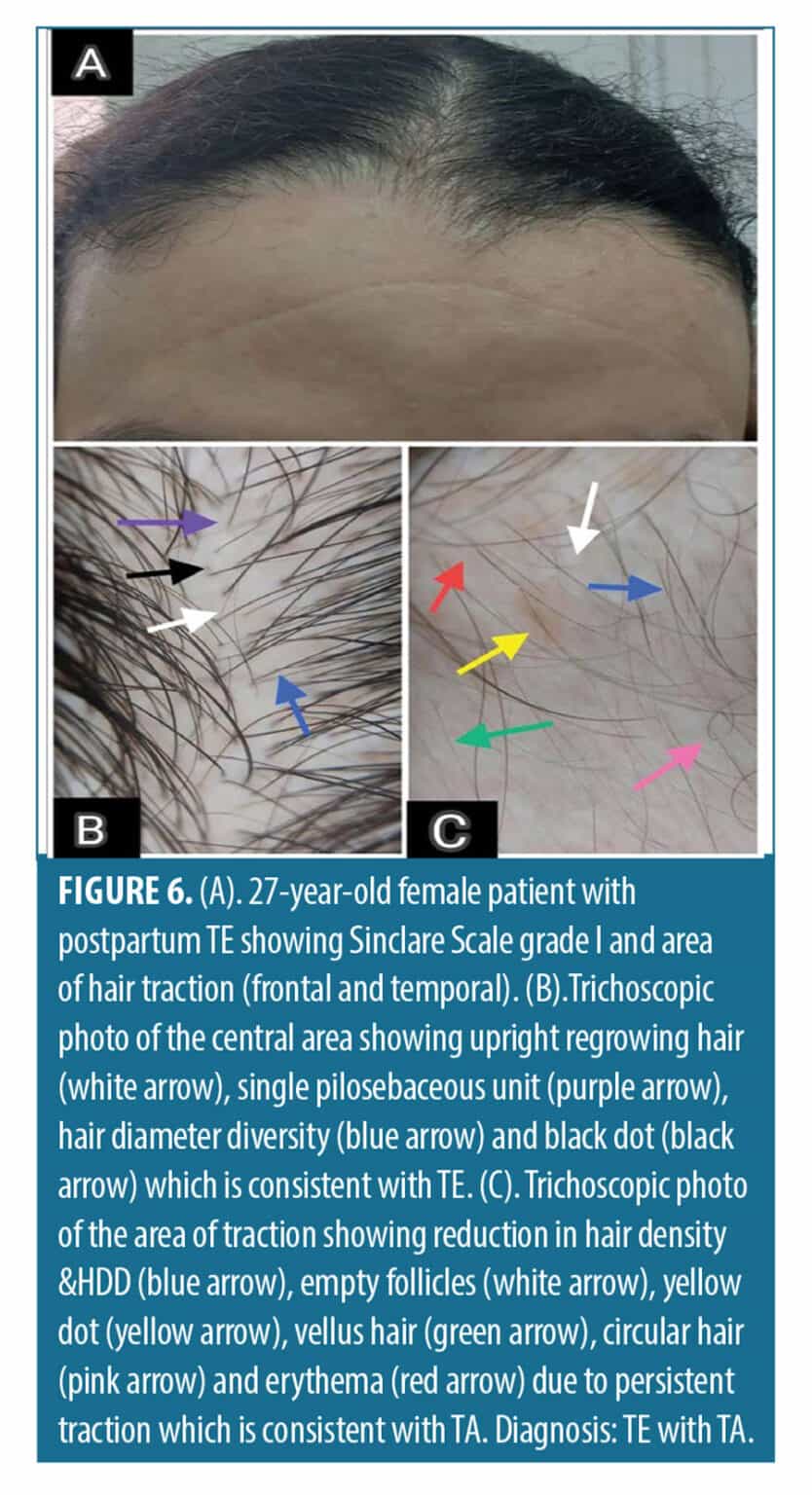 Postpartum Telogen Effluvium Unmasking Additional Latent Hair Loss ...