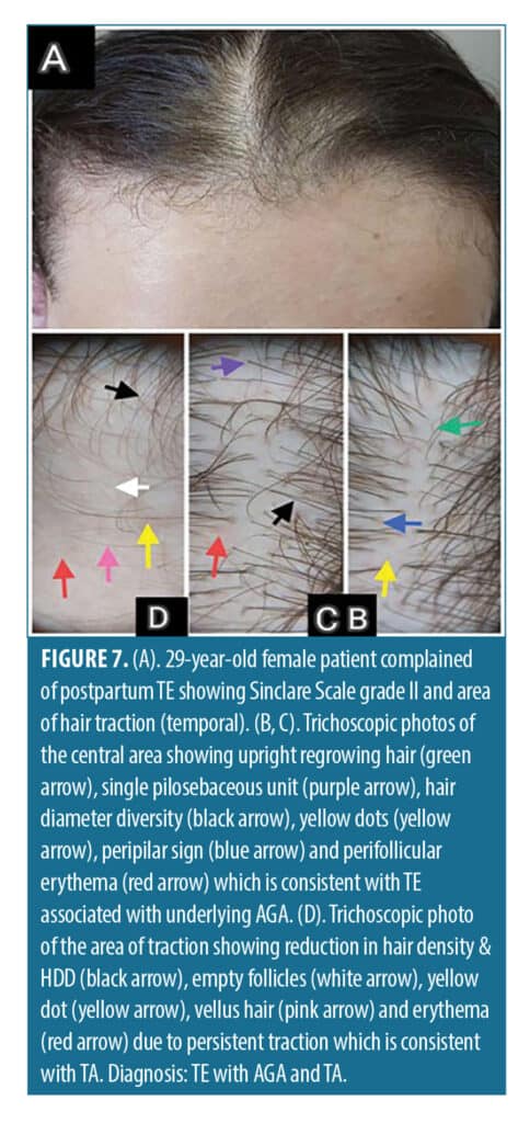 Postpartum Telogen Effluvium Unmasking Additional Latent Hair Loss ...