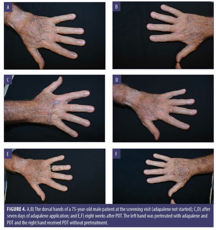 Photodynamic Therapy for Actinic Keratoses of the Upper Extremities ...
