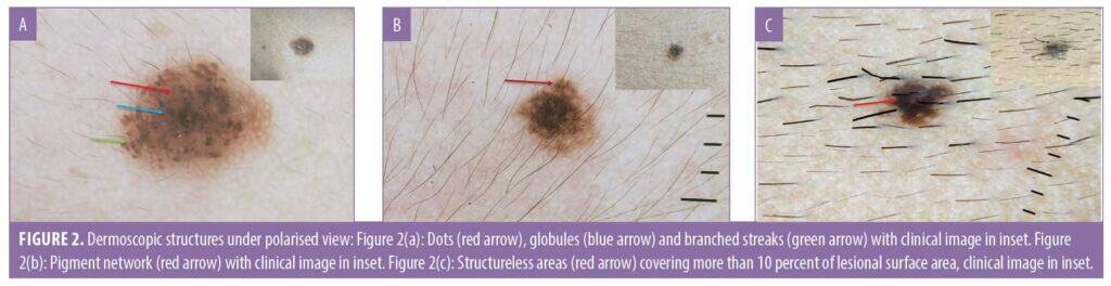 A Clinical, Dermoscopic, and Histopathological Analysis of Common ...