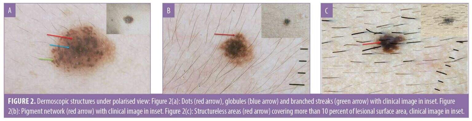 A Clinical, Dermoscopic, and Histopathological Analysis of Common ...