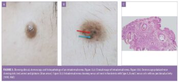 A Clinical, Dermoscopic, and Histopathological Analysis of Common ...