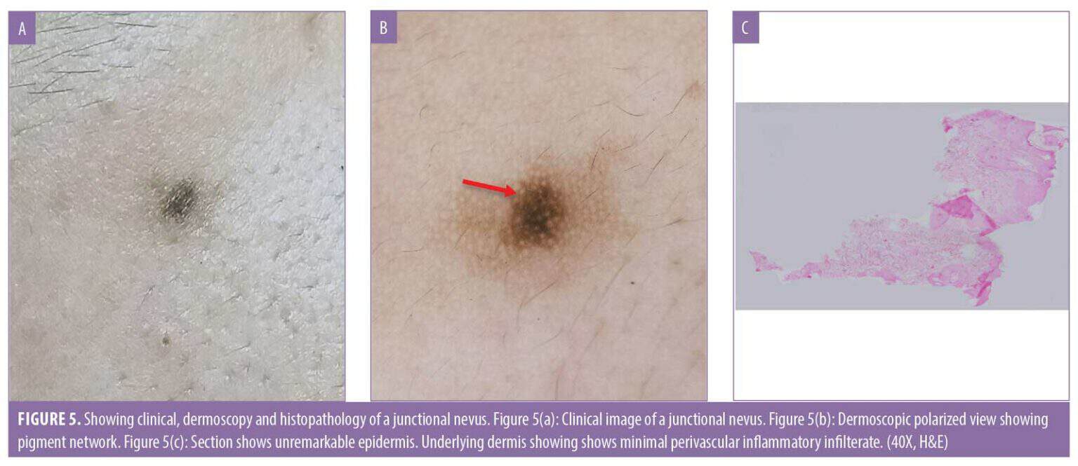 A Clinical, Dermoscopic, and Histopathological Analysis of Common ...