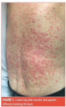 Letter to the Editor: A Case of Morbilliform Drug Eruption to ...