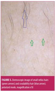 The Role of Dermoscopy in Severity Assessment of Alopecia Areata: A ...