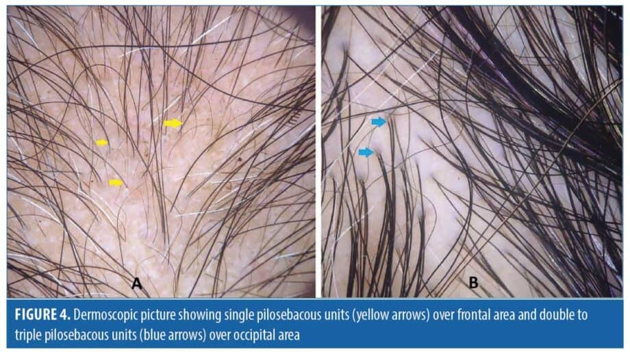 Comparison of Dermoscopic Findings in Female Androgenetic Alopecia and ...