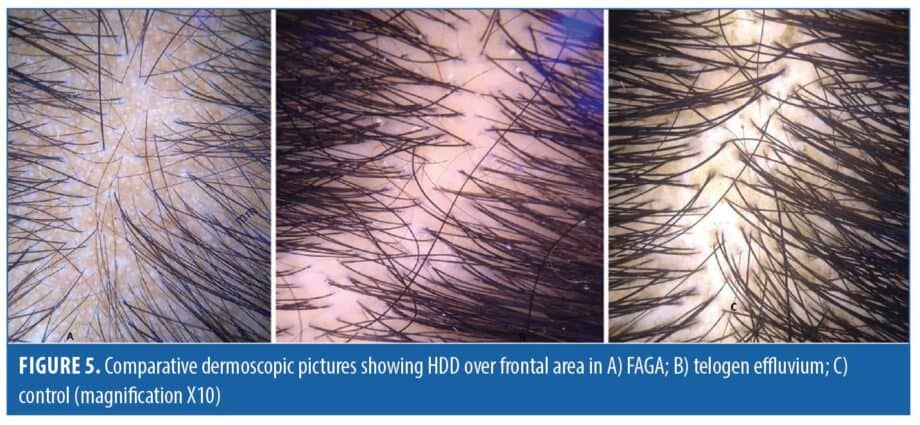 Comparison of Dermoscopic Findings in Female Androgenetic Alopecia and ...