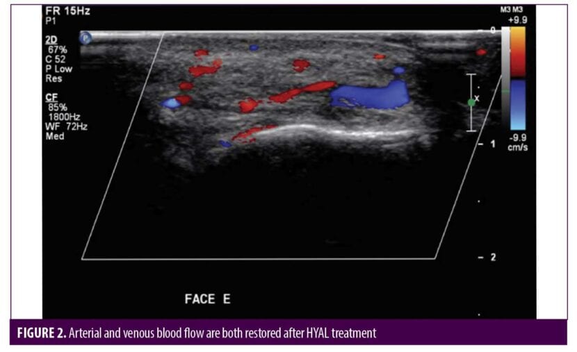 Doppler Ultrasound in the Management of Vascular Complications ...