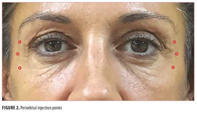Treatment of Lateral Periorbital Lines with Different Dilutions of ...