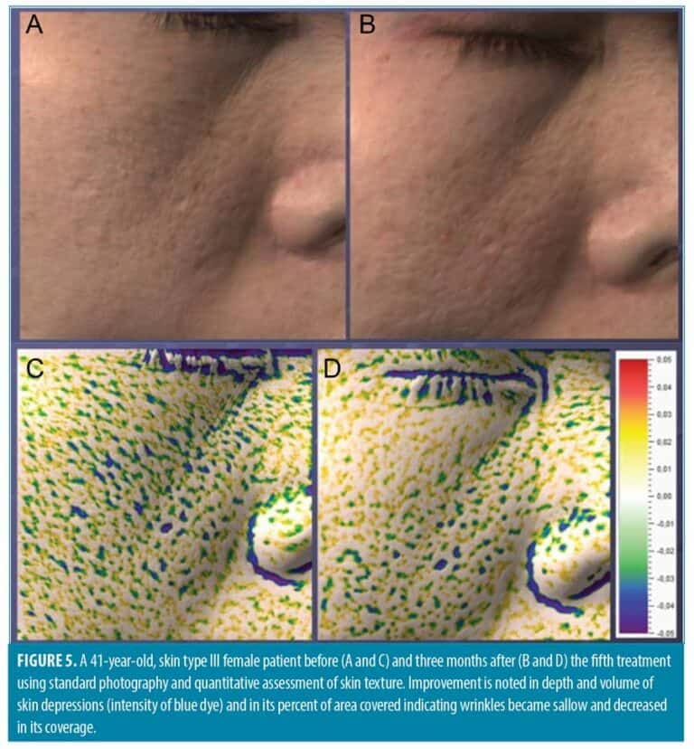 Visible and Quantifiable Improvement in Skin Roughness and Texture ...