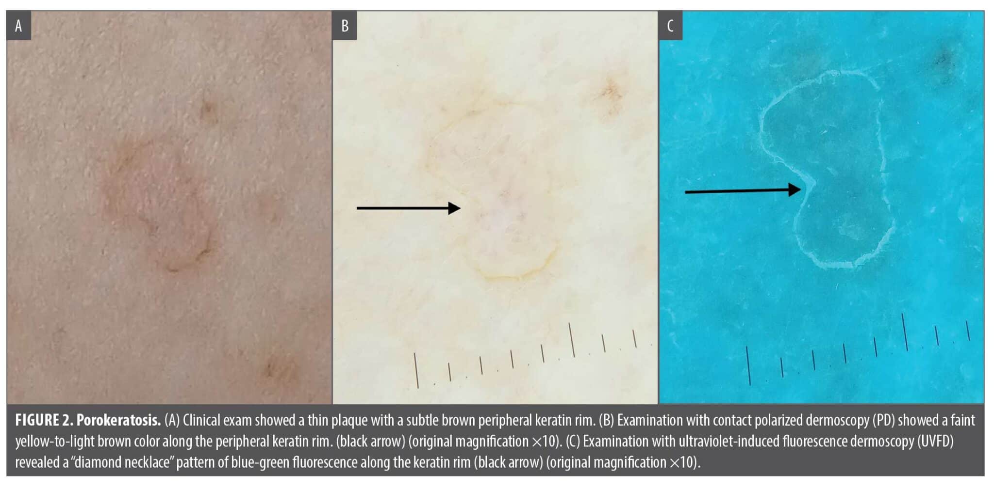Ultraviolet-Induced Fluorescence Dermoscopy: Game Changers | JCAD - The ...