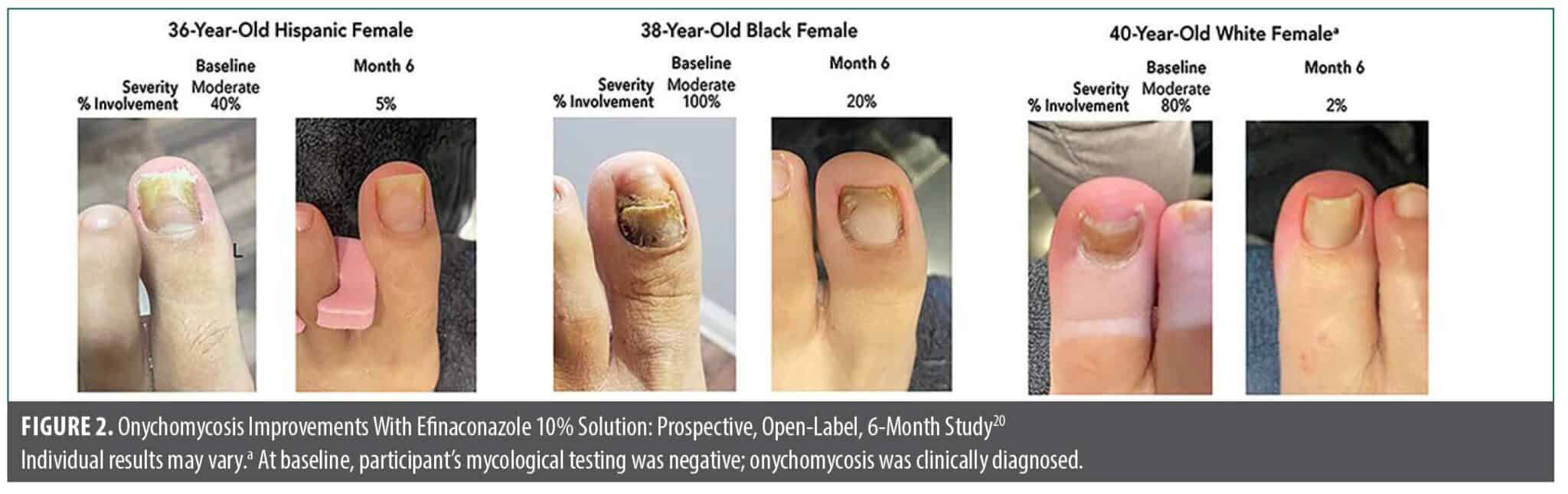 Concealing Meets Healing in the Treatment of Toenail Onychomycosis: A ...