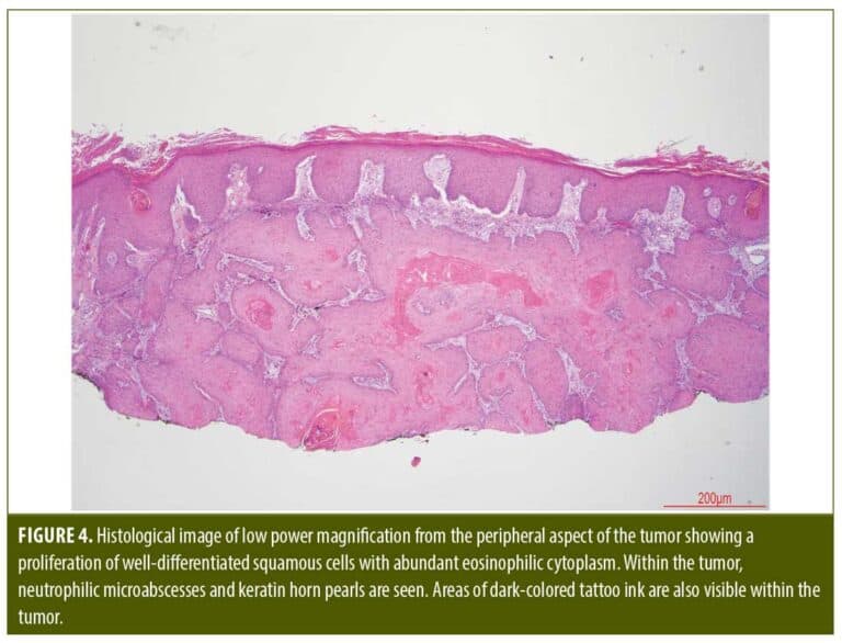 A Report of a Keratoacanthoma-Type Cutaneous Squamous Cell Carcinoma ...