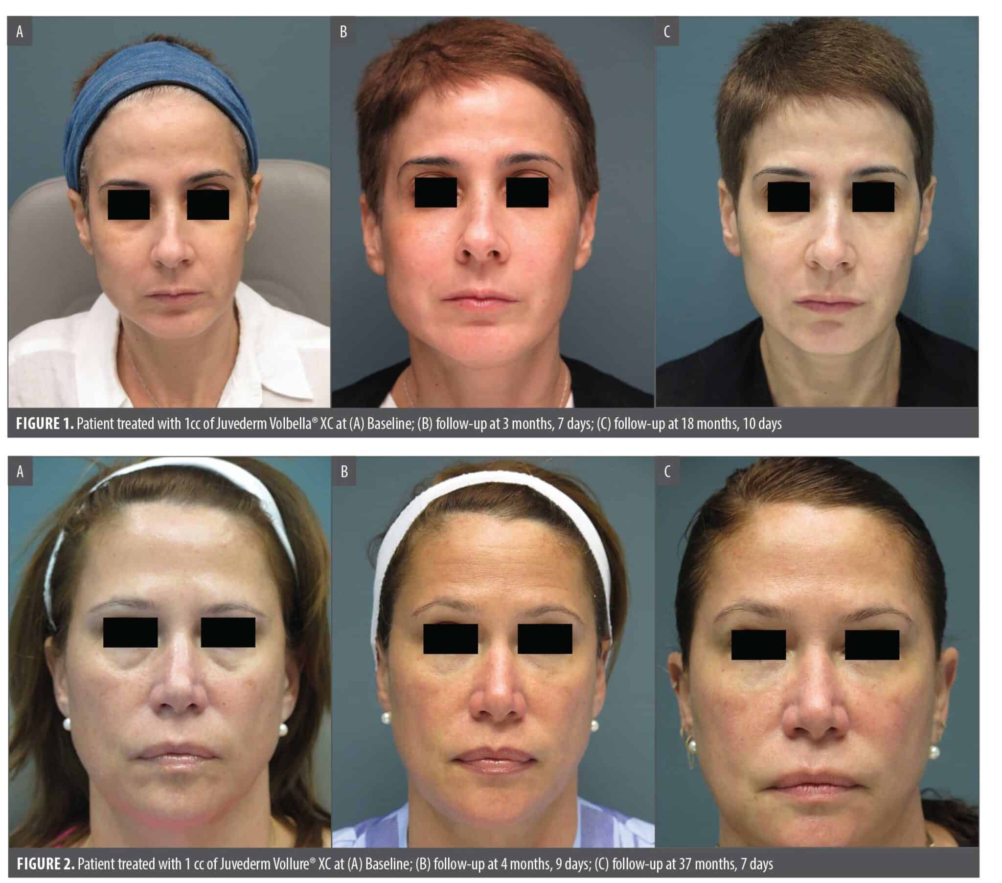 Long-Term Effects of Tear Trough Hyaluronic Acid Filler: A ...