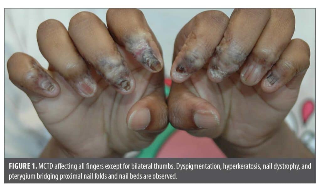 Refractory Acrodermatitis Continua of Hallopeau in a Pediatric Patient ...