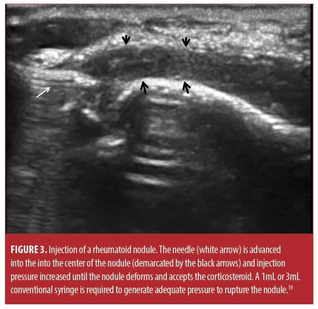 Outcomes and Complications of Corticosteroid Injection of Rheumatoid ...