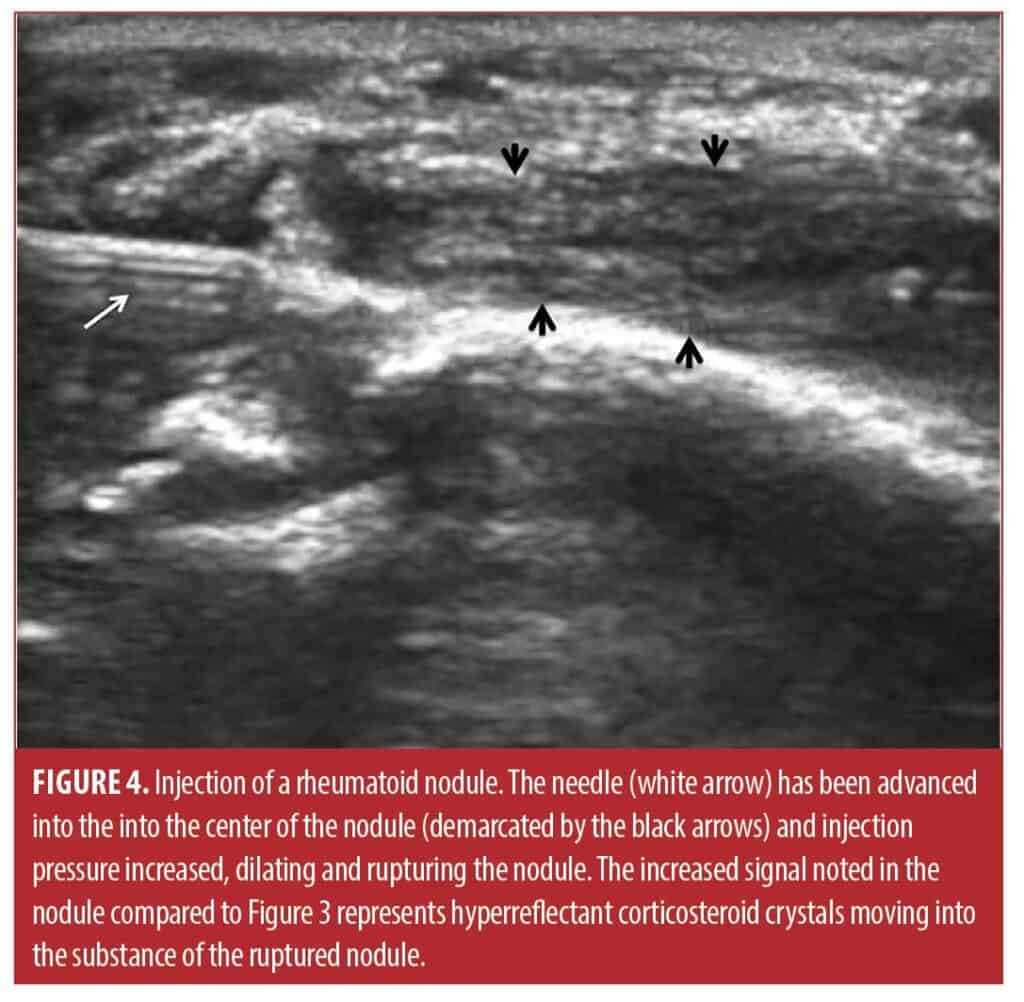 Outcomes and Complications of Corticosteroid Injection of Rheumatoid ...