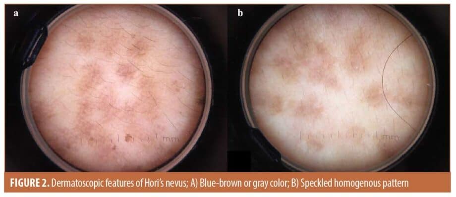 A Comparative Study of Dermatoscopic Features of Melasma and Hori’s ...