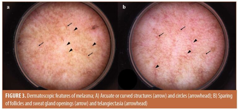 A Comparative Study of Dermatoscopic Features of Melasma and Hori’s ...