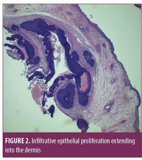 Not Your Average Skin Cancer: A Rare Case of Pilomatrix Carcinoma ...